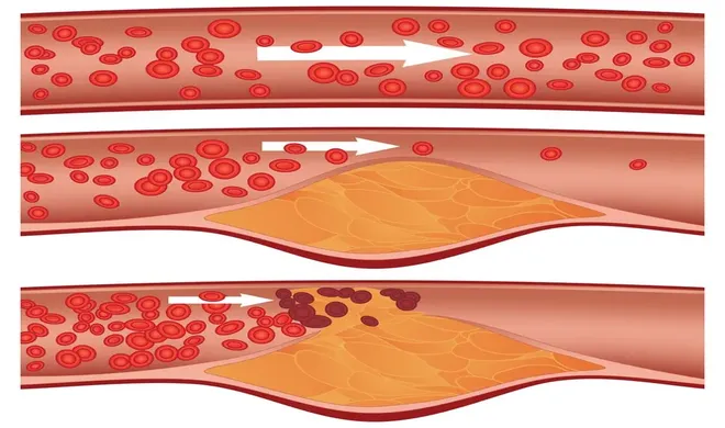 What level of ldl hdl ratio is dangerously high